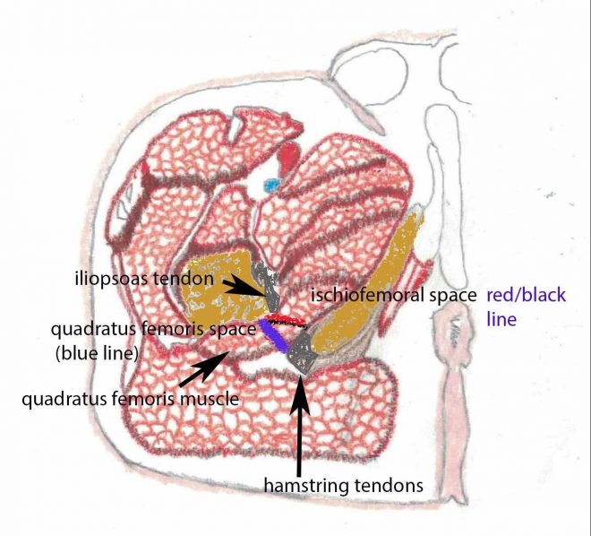 MRI NEWSLETTER: Ischiofemoral Impingement - Radius Imaging